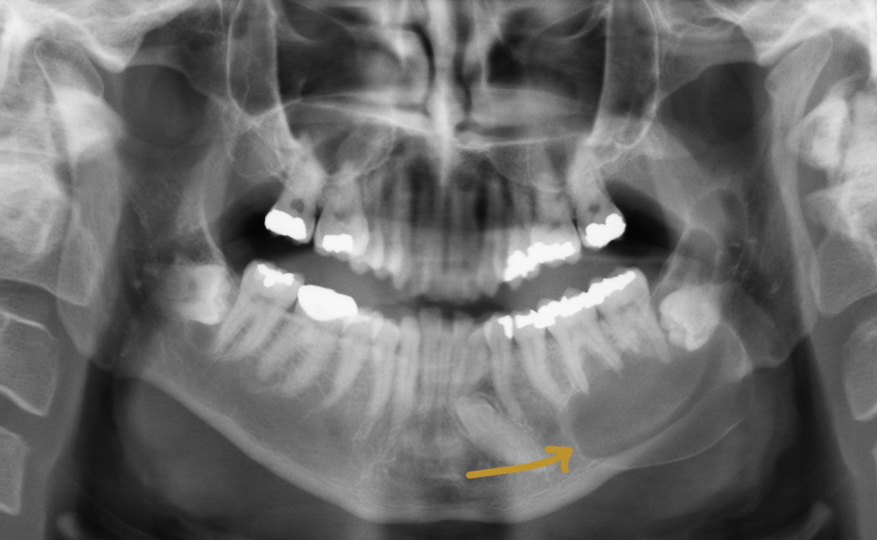 Oral Surgery Before and After | Oral Surgeon Arlington VA | Dr. Moe Hakim